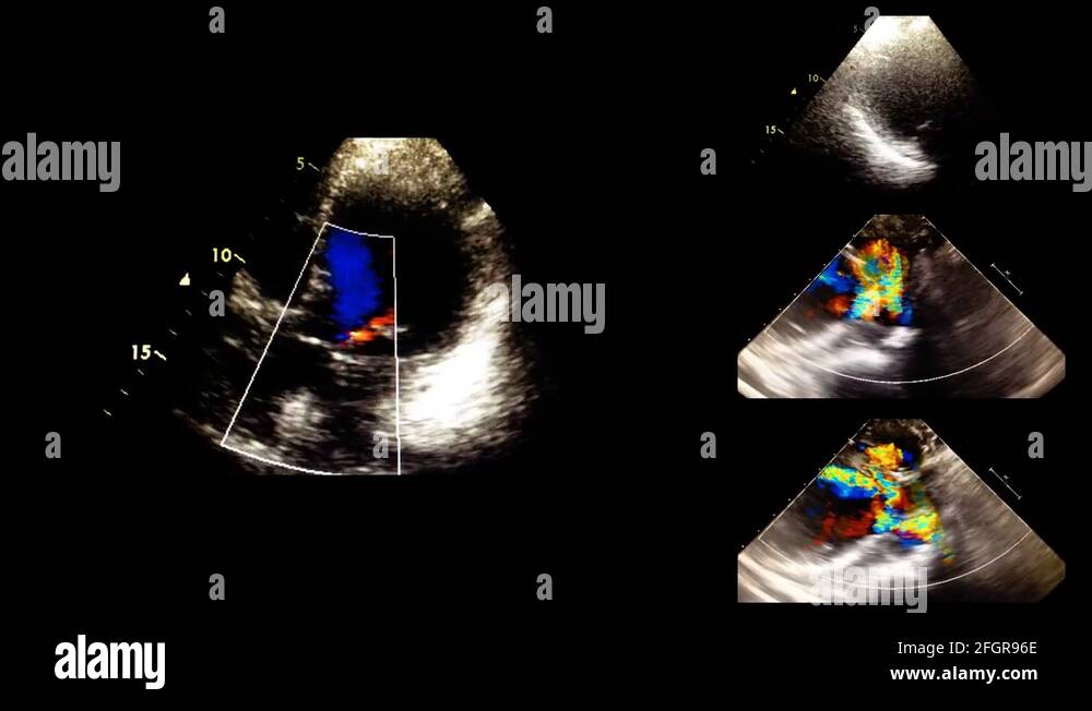 Echocardiography (ultrasound examination of the heart Stock Video ...