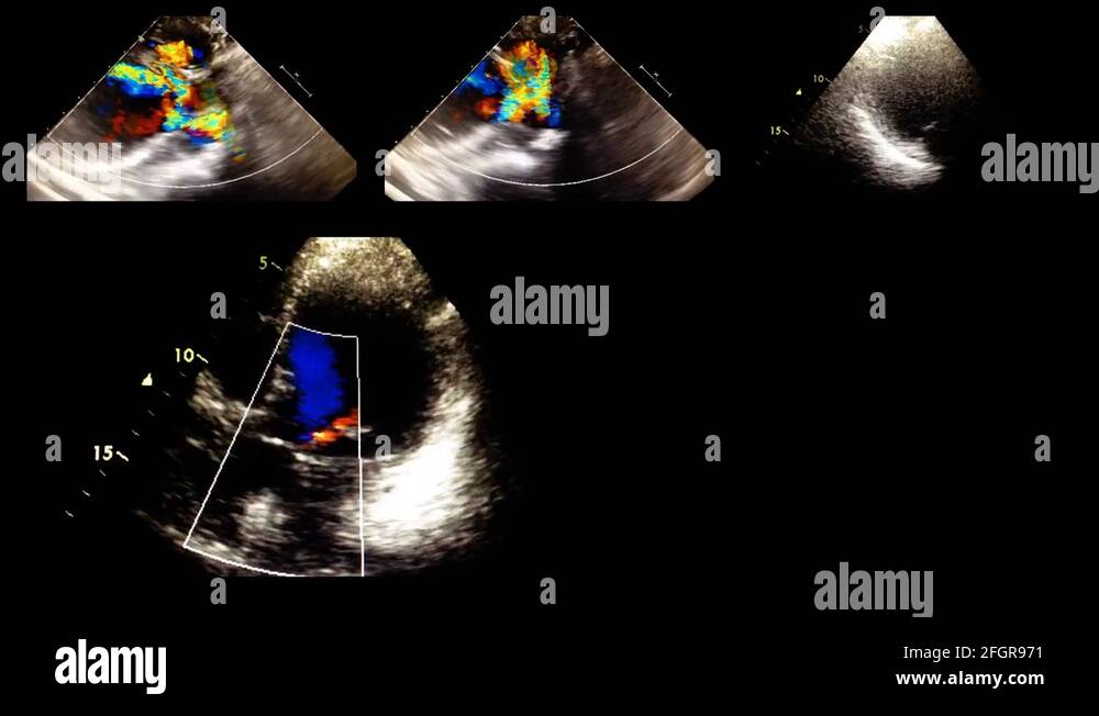 Echocardiography (ultrasound examination of the heart Stock Video ...