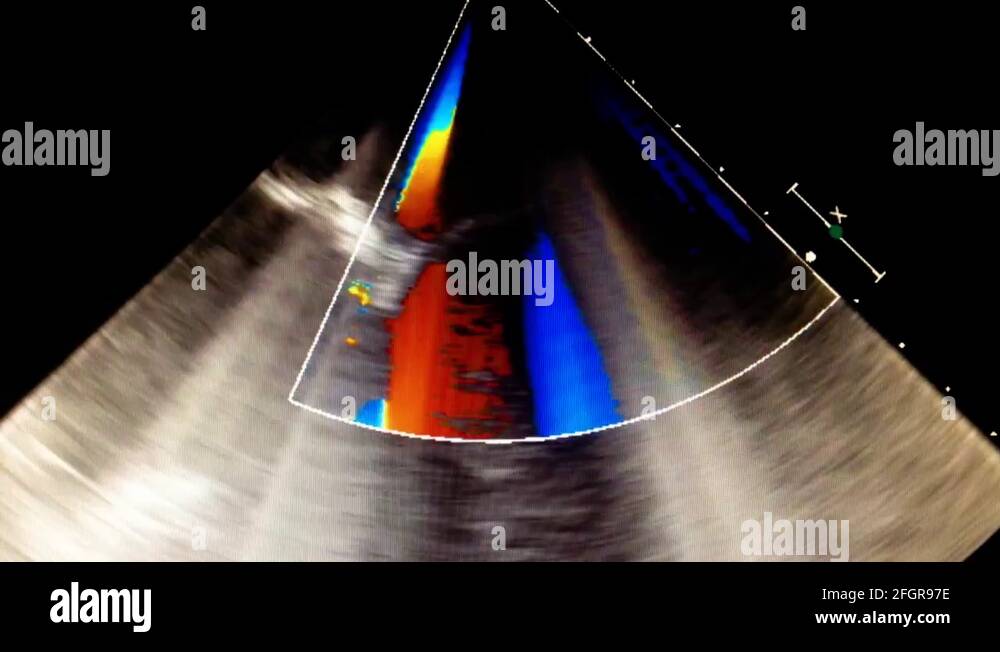 Echocardiography (ultrasound examination of the heart Stock Video ...