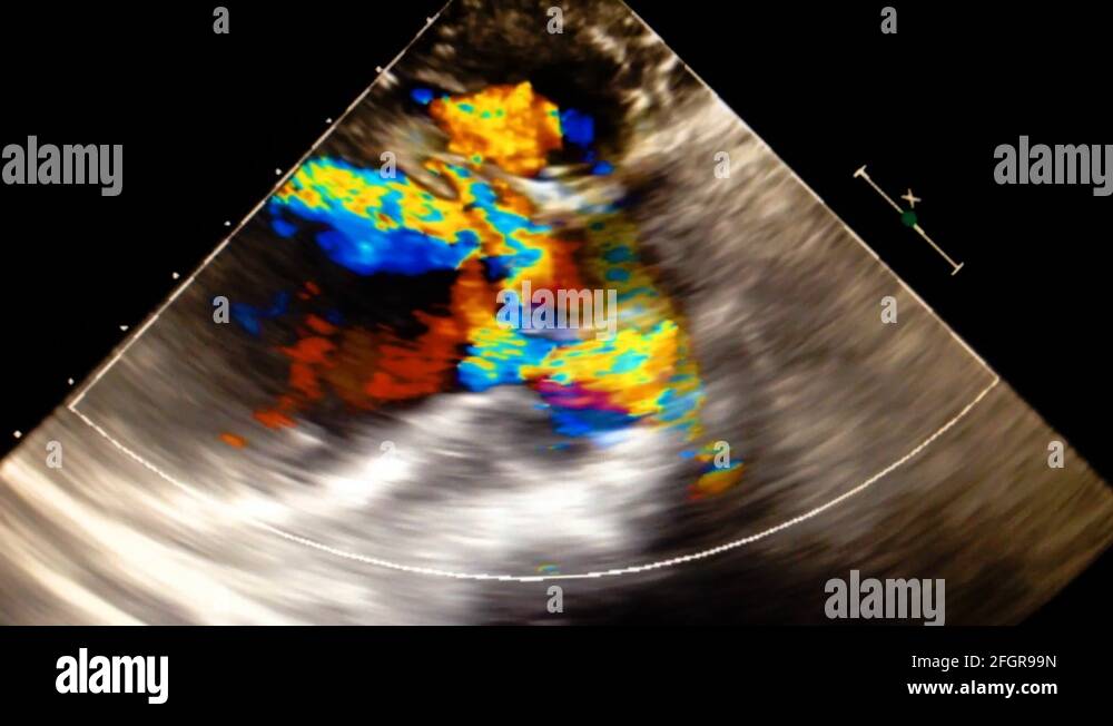 Echocardiography (ultrasound examination of the heart Stock Video ...