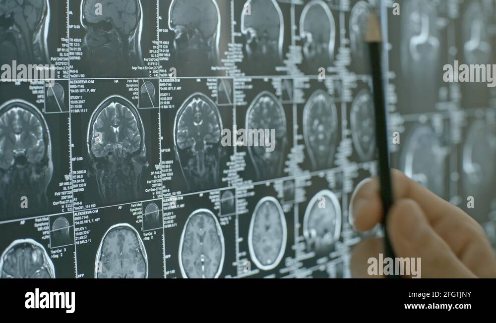 Mri brain tumor Stock Videos & Footage - HD and 4K Video Clips - Alamy