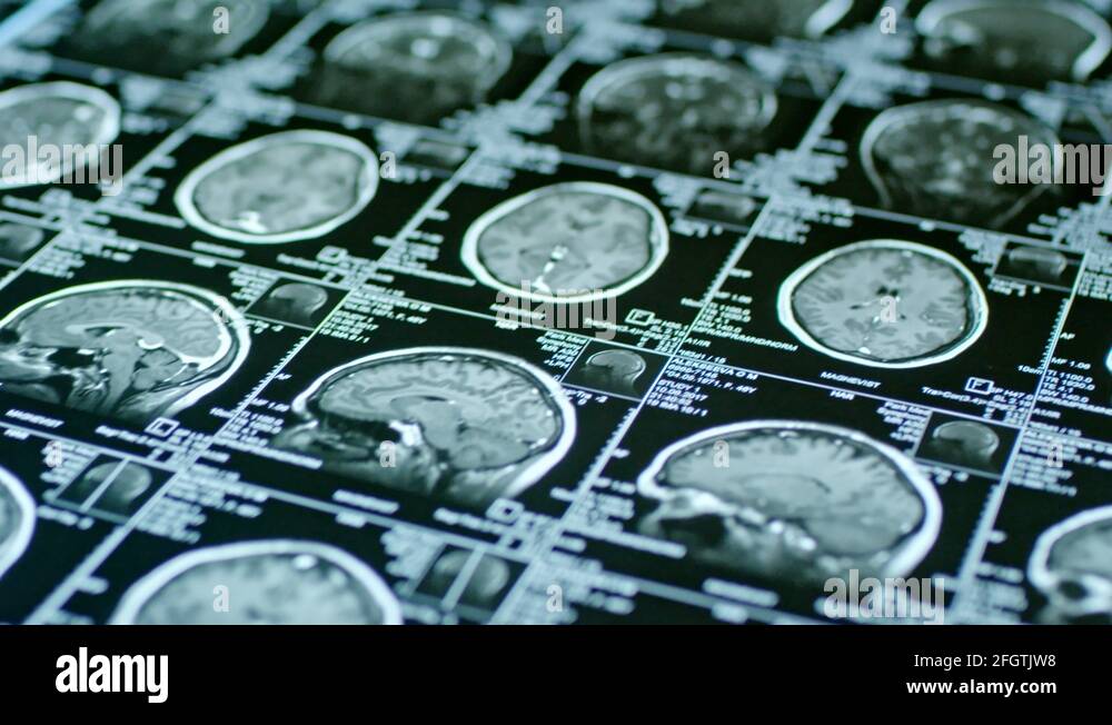 Mri scan of brain Stock Videos & Footage - HD and 4K Video Clips - Alamy