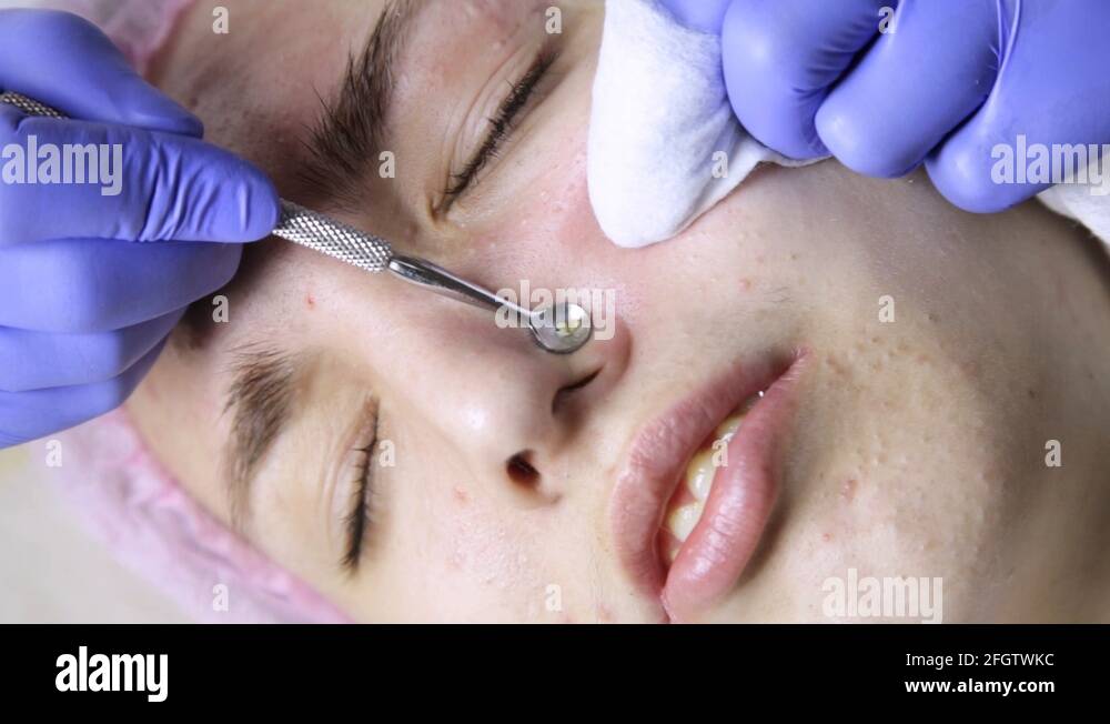 Squeezing pimple acne treatments. Young woman receiving beauty face ...