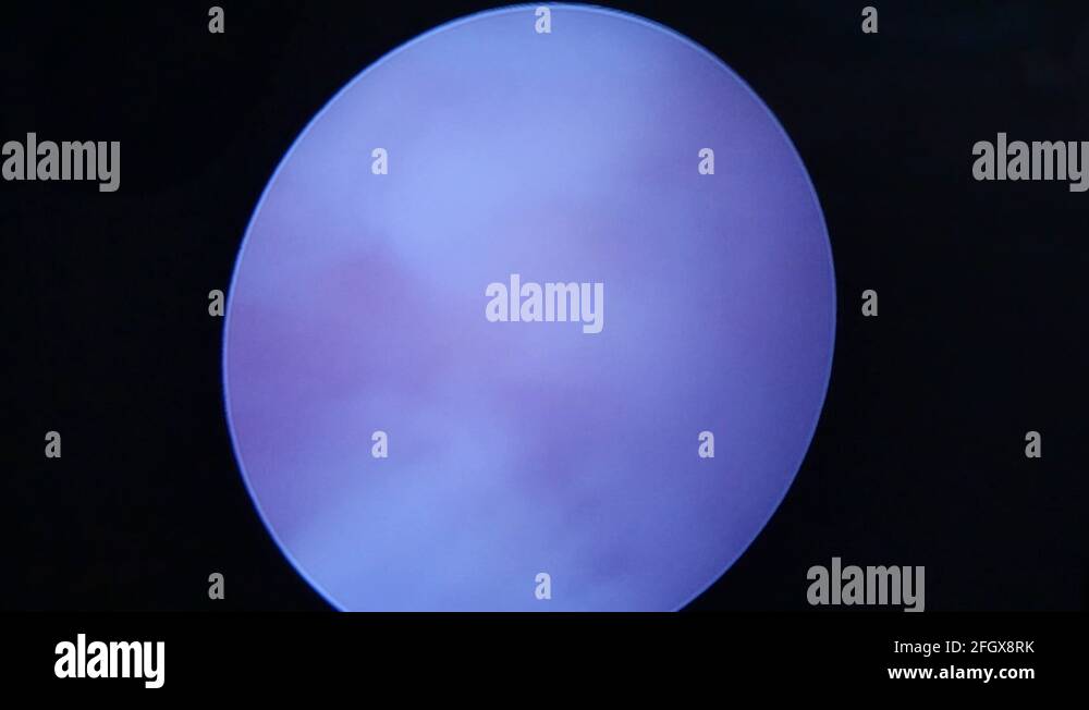 Female neck of uterus womb cervix uteri on monitor gynecological ...