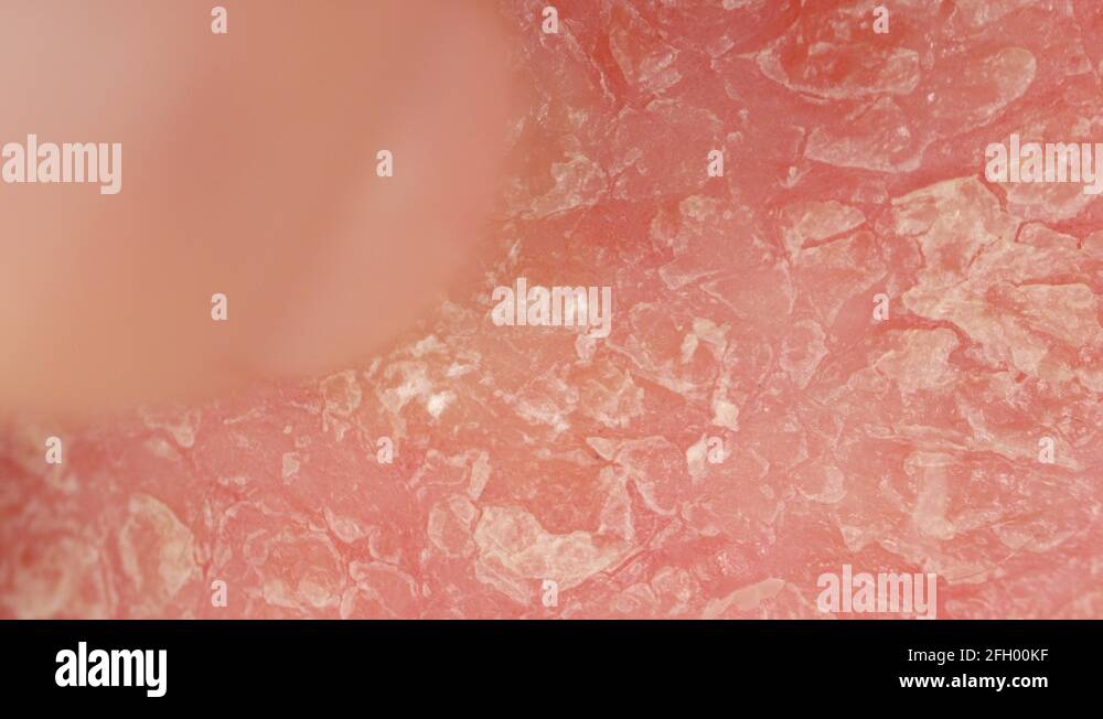 CLOSE UP, MACRO: Finger scratching red skin rash affected by psoriasis ...
