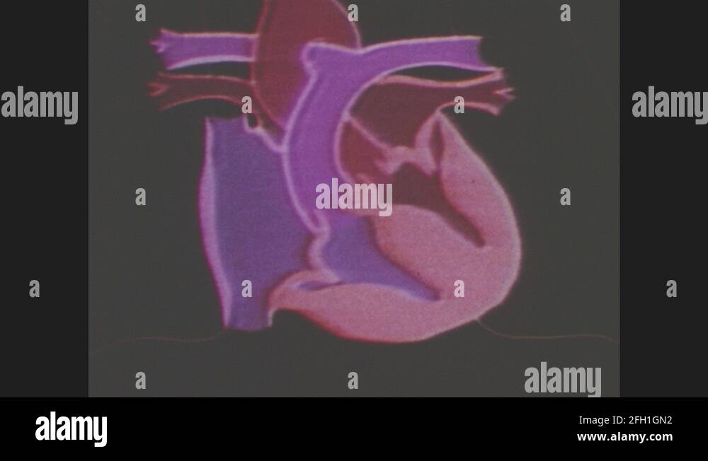 1970s: Two dimensional animated representation of beating heart. Arrows ...