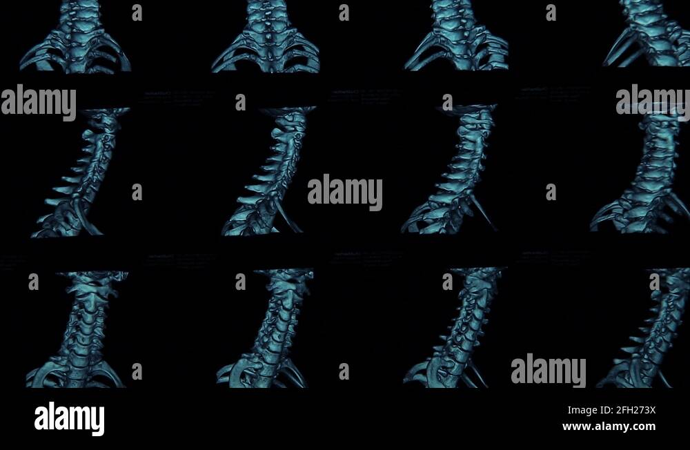 Broken spine Stock Videos & Footage - HD and 4K Video Clips - Alamy