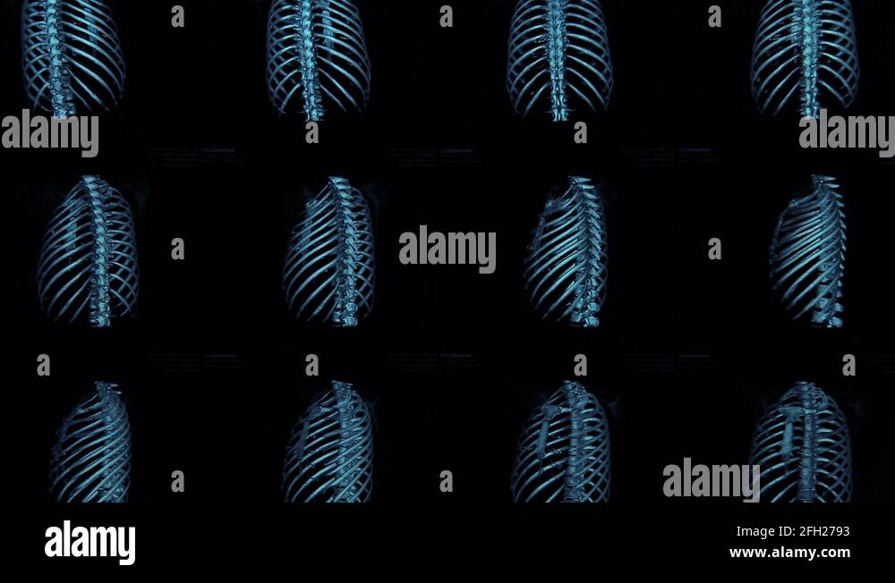 Thorax surgery Stock Videos & Footage - HD and 4K Video Clips - Alamy