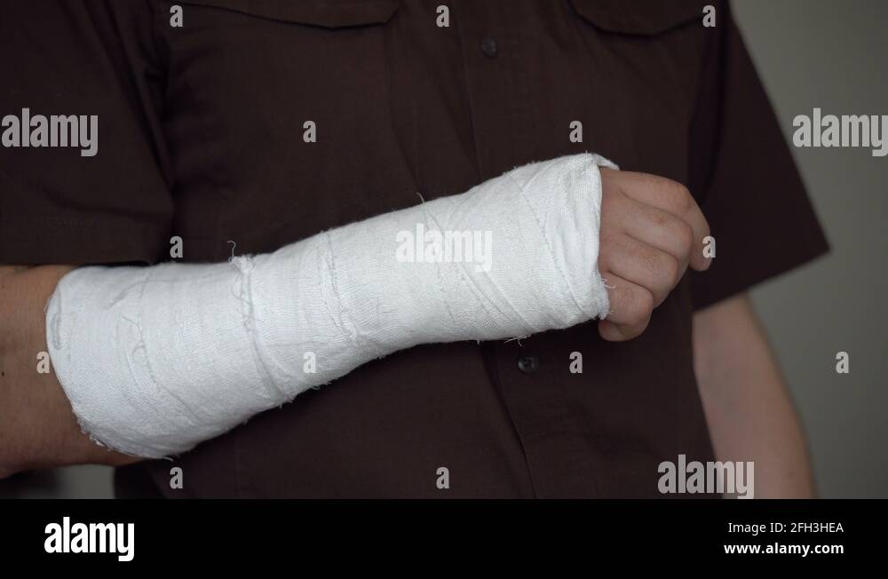 A man with a broken right hand in a plaster is standing indoors. A ...