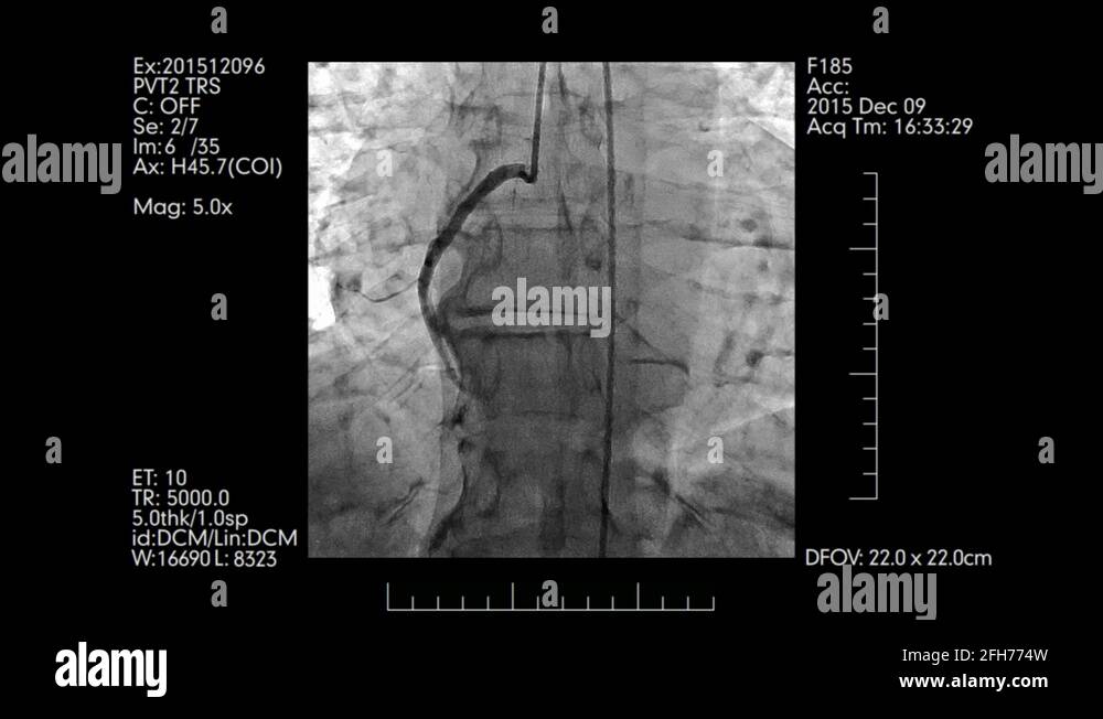 Heart vessels angiography testing display with medical info Stock Video ...