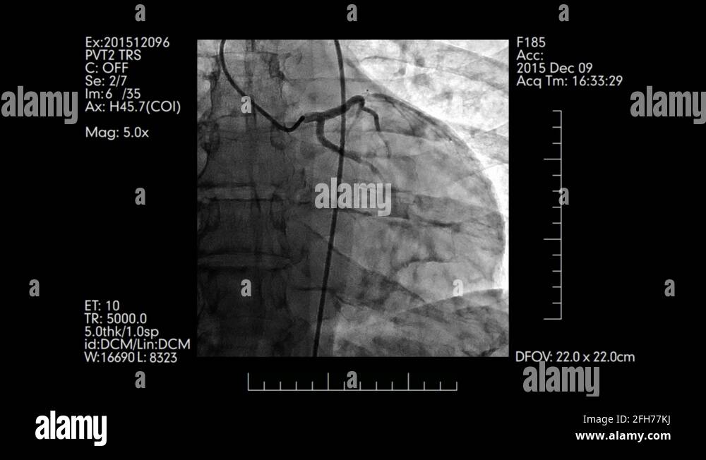 Coronary angiography Stock Videos & Footage - HD and 4K Video Clips - Alamy