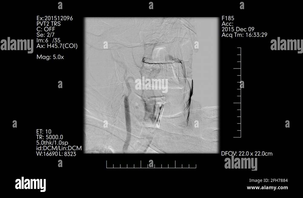Angiogram x ray brain artery Stock Videos & Footage - HD and 4K Video ...