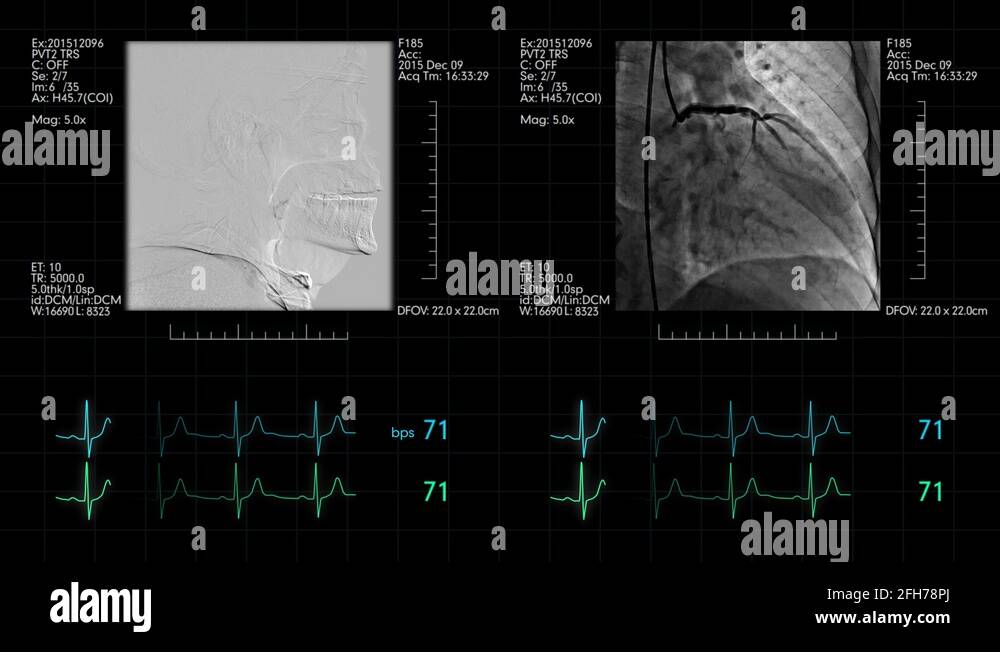 Coronary angiogram Stock Videos & Footage - HD and 4K Video Clips - Alamy