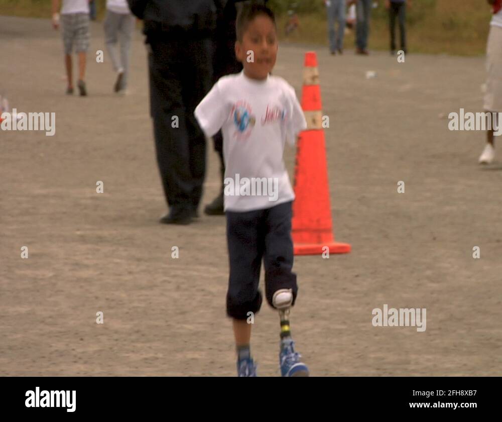 A young boy with no arms and one leg and a prosthetic leg finishing a ...