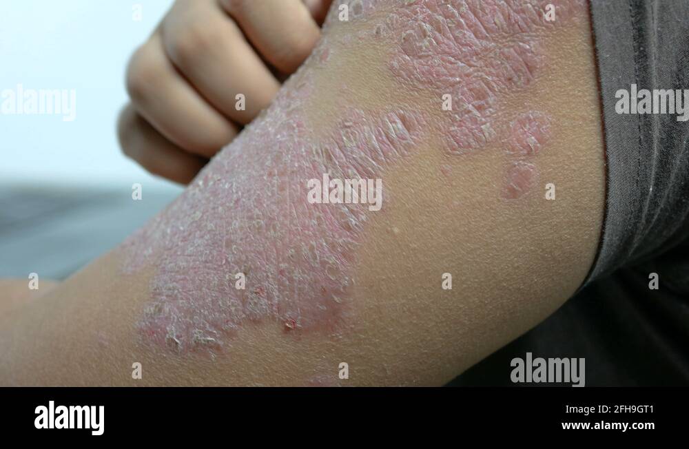 Man itchy rash arm Stock Videos & Footage - HD and 4K Video Clips - Alamy