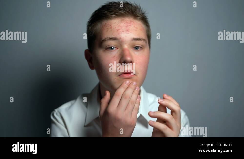 Teenager feeling sad of appearance insecurities. Acne face Stock Video ...