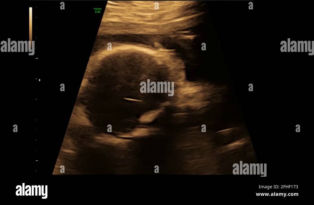 Fetal ultrasound Stock Videos & Footage - HD and 4K Video Clips - Alamy