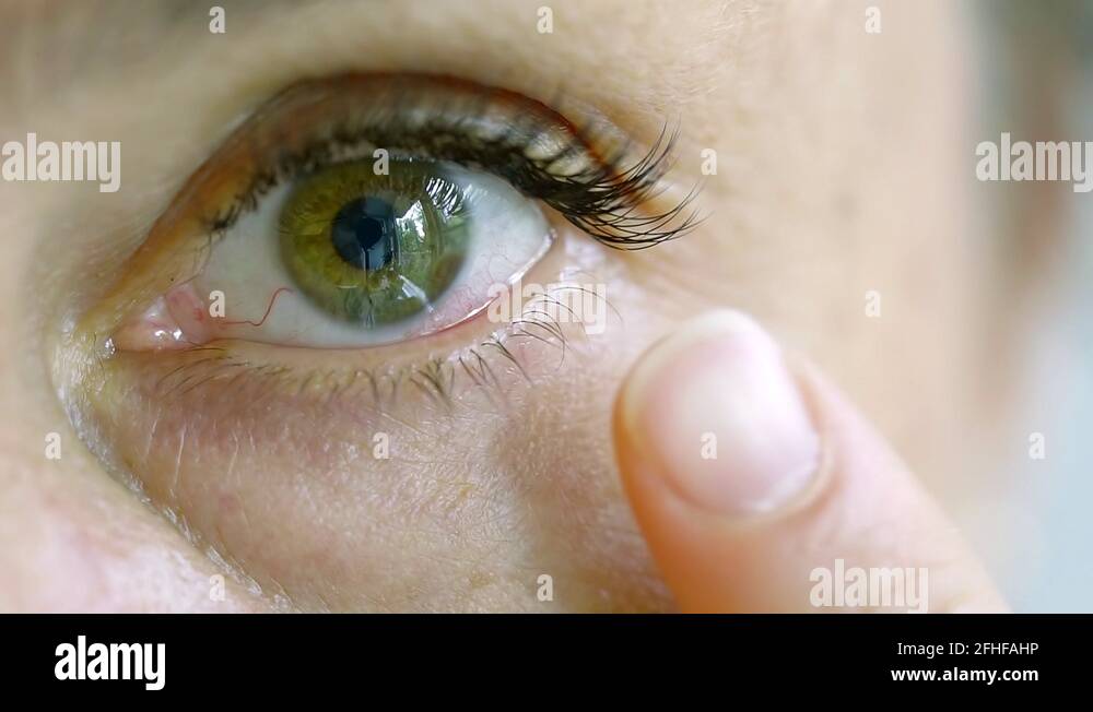 Eye burn Stock Videos & Footage - HD and 4K Video Clips - Alamy