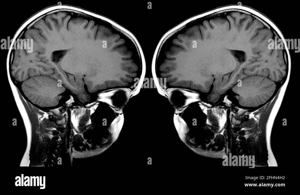 Brain imaging mri Stock Videos & Footage - HD and 4K Video Clips - Alamy