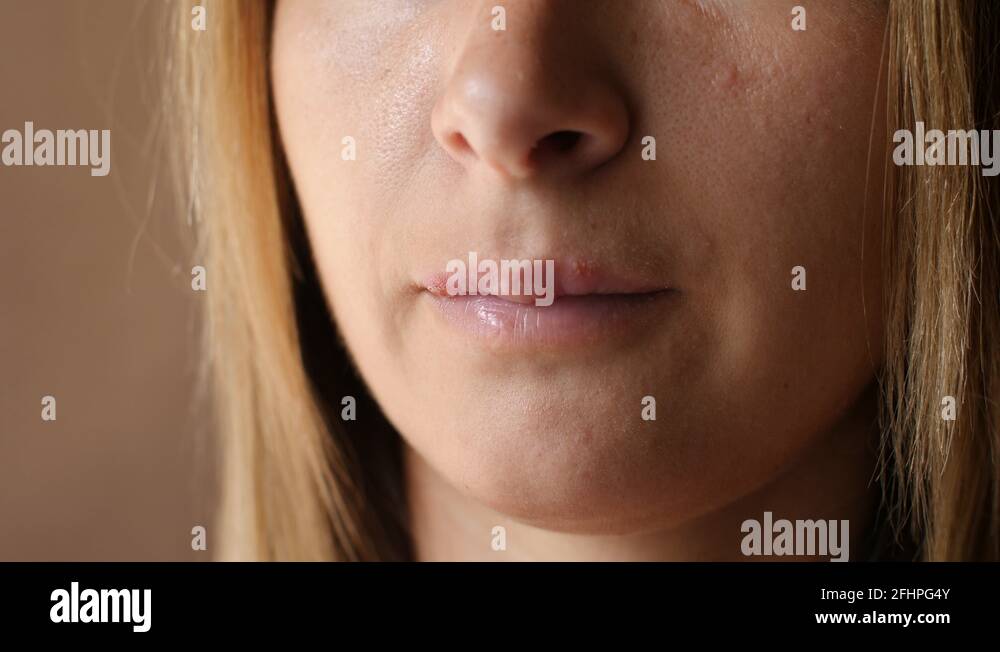 Women's lip ulcers herpes closeup. Beautiful lips were covered with ...