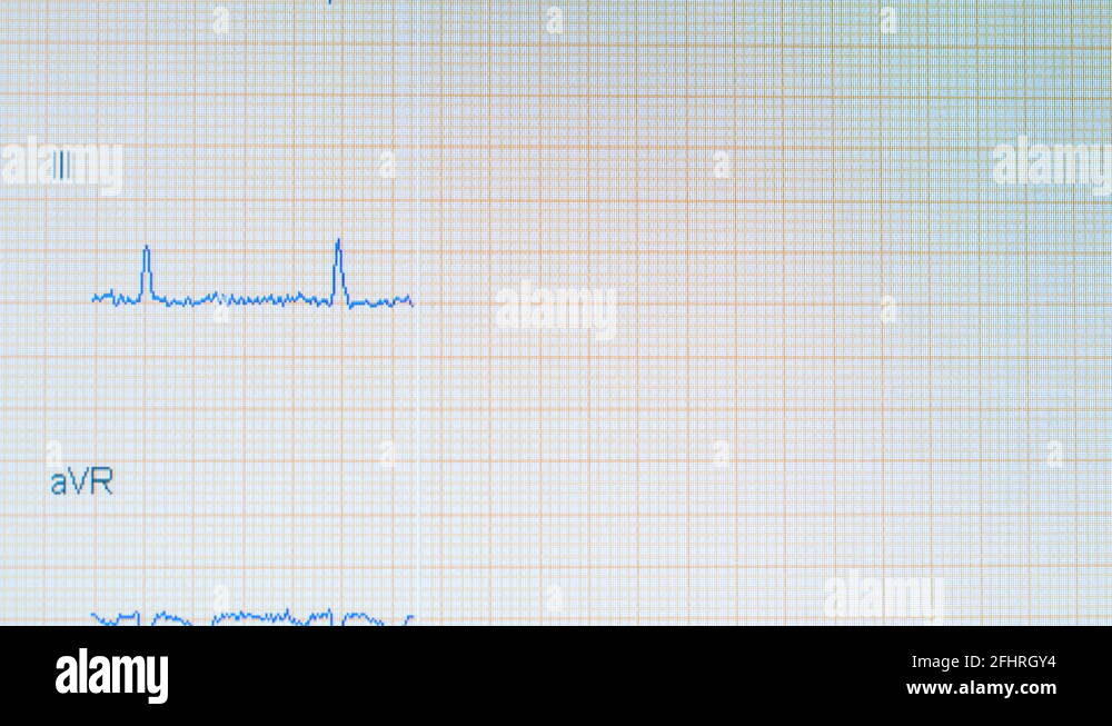 Ecg normal heart beat Stock Videos & Footage - HD and 4K Video Clips ...