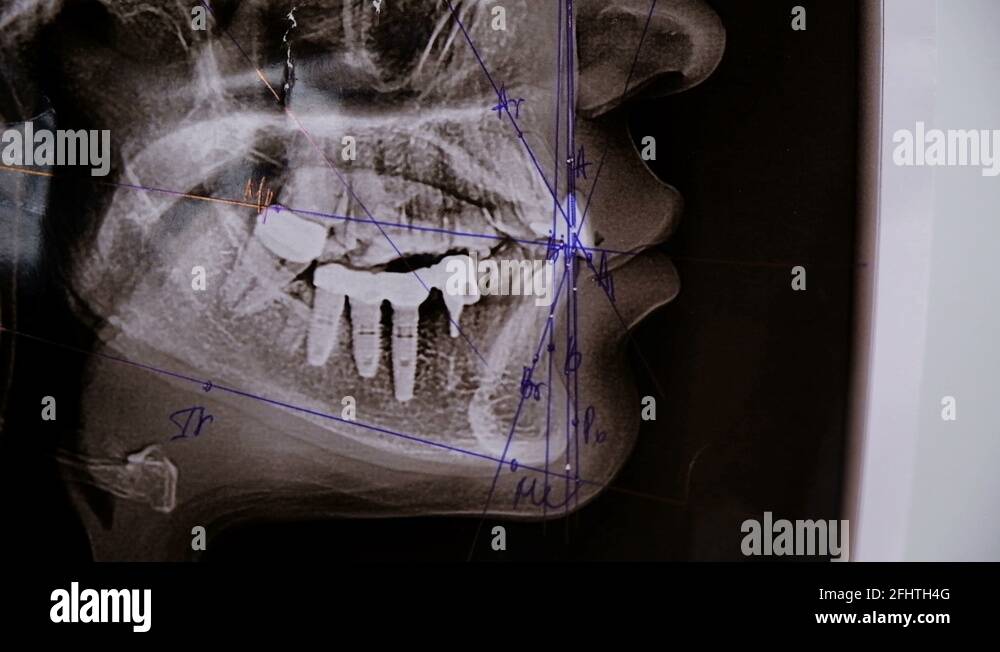 Lateral plan Stock Videos & Footage - HD and 4K Video Clips - Alamy