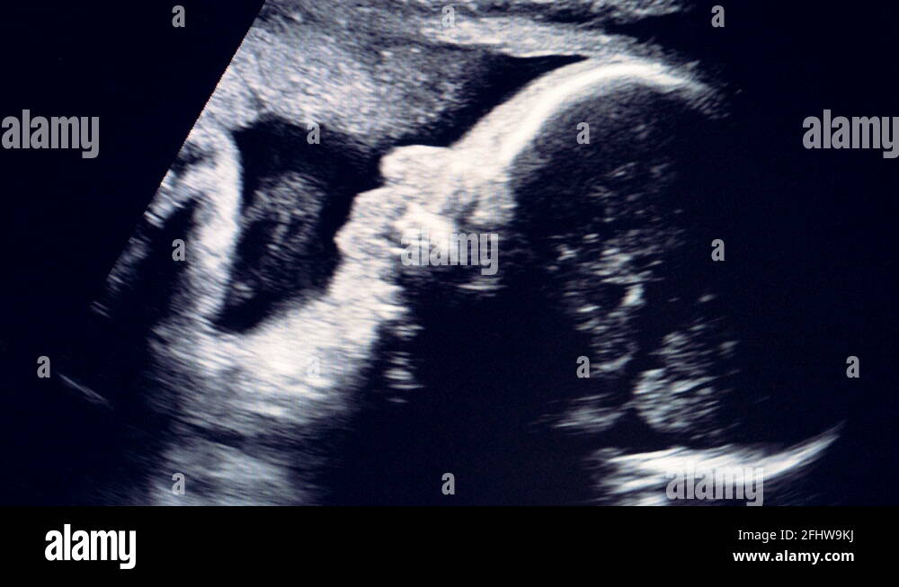 Foetus scan 3d Stock Videos & Footage - HD and 4K Video Clips - Alamy