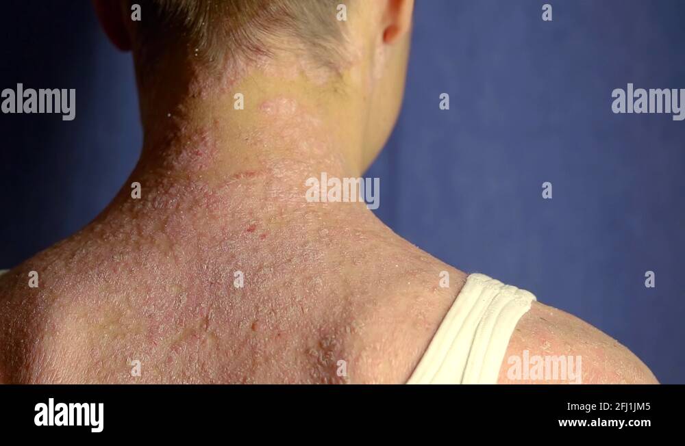 Standing and back view back patient Stock Videos & Footage - HD and 4K ...