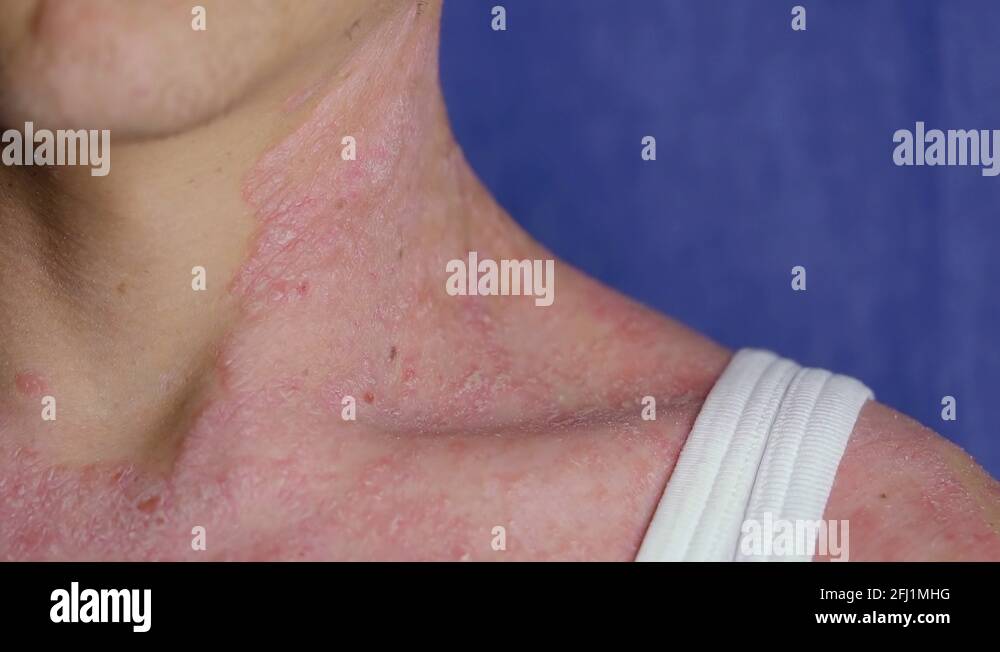 Psoriasis patches Stock Videos & Footage - HD and 4K Video Clips - Alamy