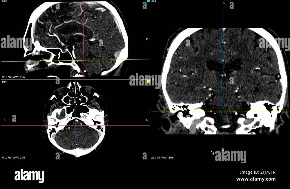 Human tomography x-ray/ultrasound with multipleing images of the brain ...