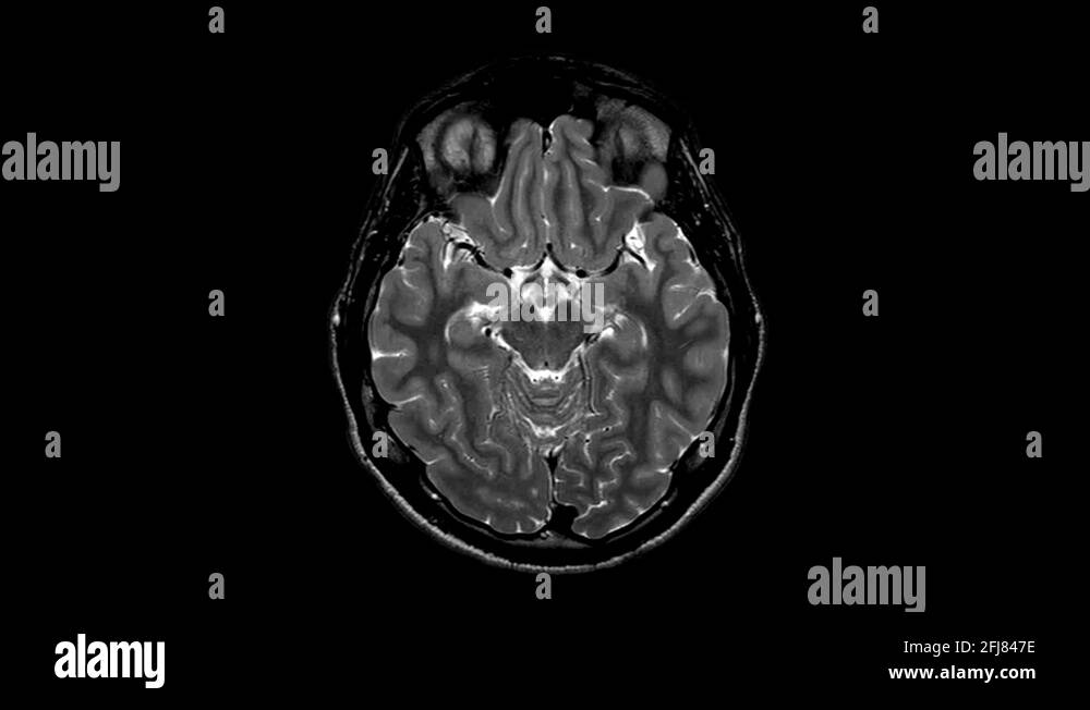 Human brain MRI/Ultrasound tomography waves, t2 weighted in a scanning ...