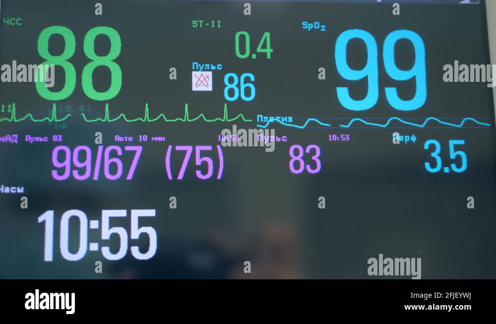 Ambulatory ecg monitor Stock Videos & Footage - HD and 4K Video Clips ...
