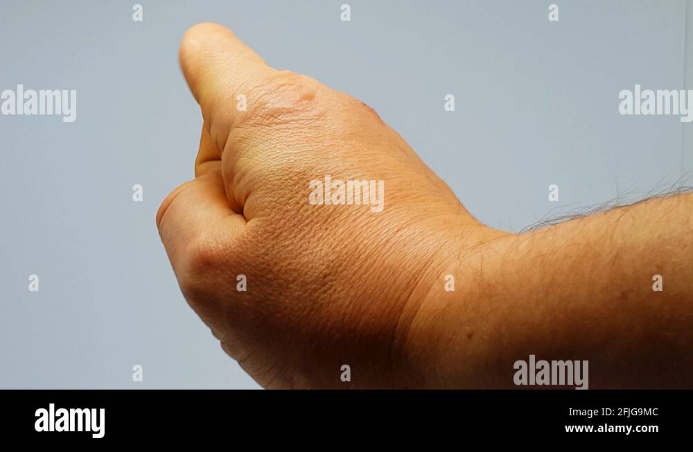 Amputation of the index finger Stock Videos & Footage - HD and 4K Video ...