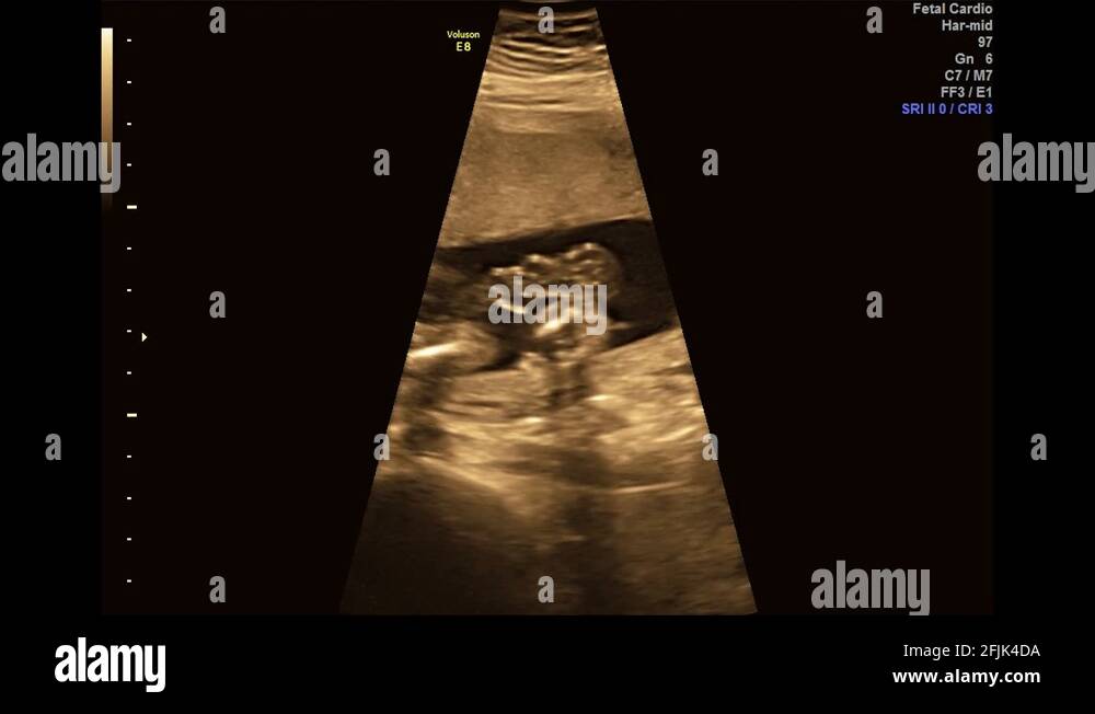 20 weeks scan Stock Videos & Footage - HD and 4K Video Clips - Alamy