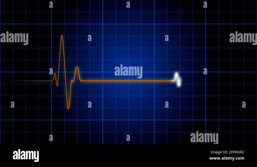 Electrocardiogram of a healthy heart Stock Videos & Footage - HD and 4K ...