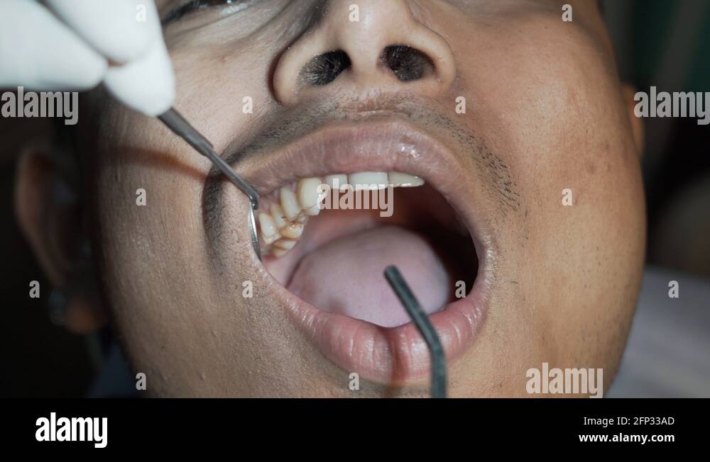 Cavity cleaning Stock Videos & Footage - HD and 4K Video Clips - Alamy