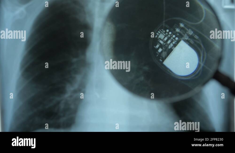 X-Ray Image of Chest with Artificial Cardiac Pacemaker Under Magnifying ...