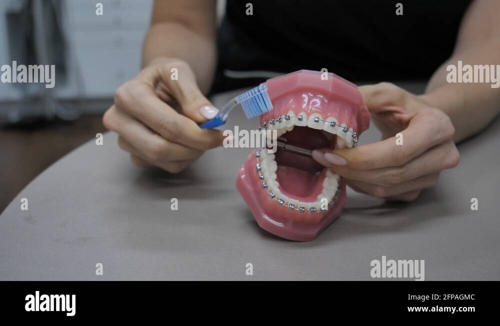 Braces for overbite Stock Videos & Footage - HD and 4K Video Clips - Alamy