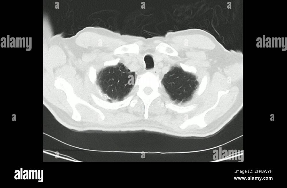 Computed tomography chest Stock Videos & Footage - HD and 4K Video ...