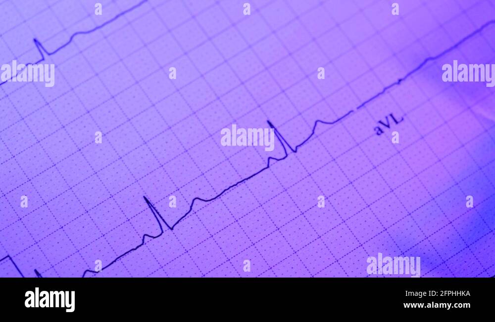 ecg heart monitor readout, syringes and medicine vials Stock Video ...
