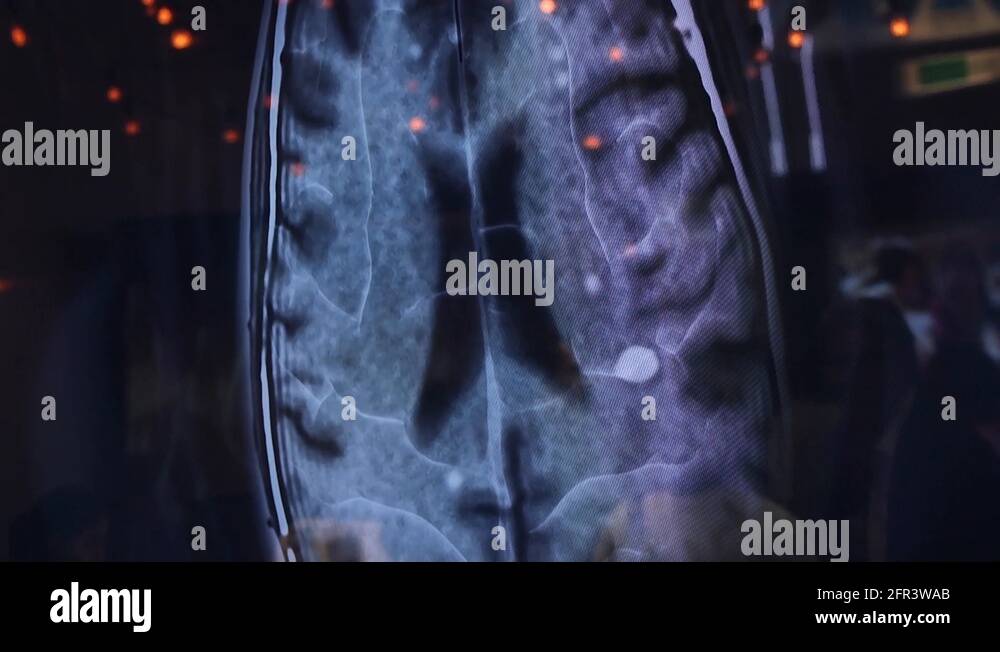 Lobotomy scan Stock Videos & Footage - HD and 4K Video Clips - Alamy