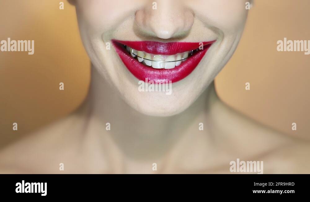 Beautiful Smiling Girl with Retainer for Teeth, With red lips, Close-up ...
