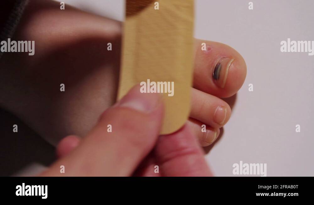 Foot plaster Stock Videos & Footage - HD and 4K Video Clips - Alamy