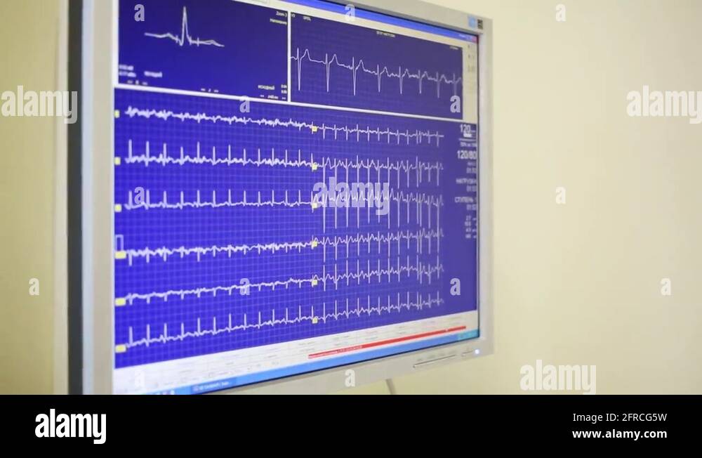 Stress test ecg Stock Videos & Footage - HD and 4K Video Clips - Alamy