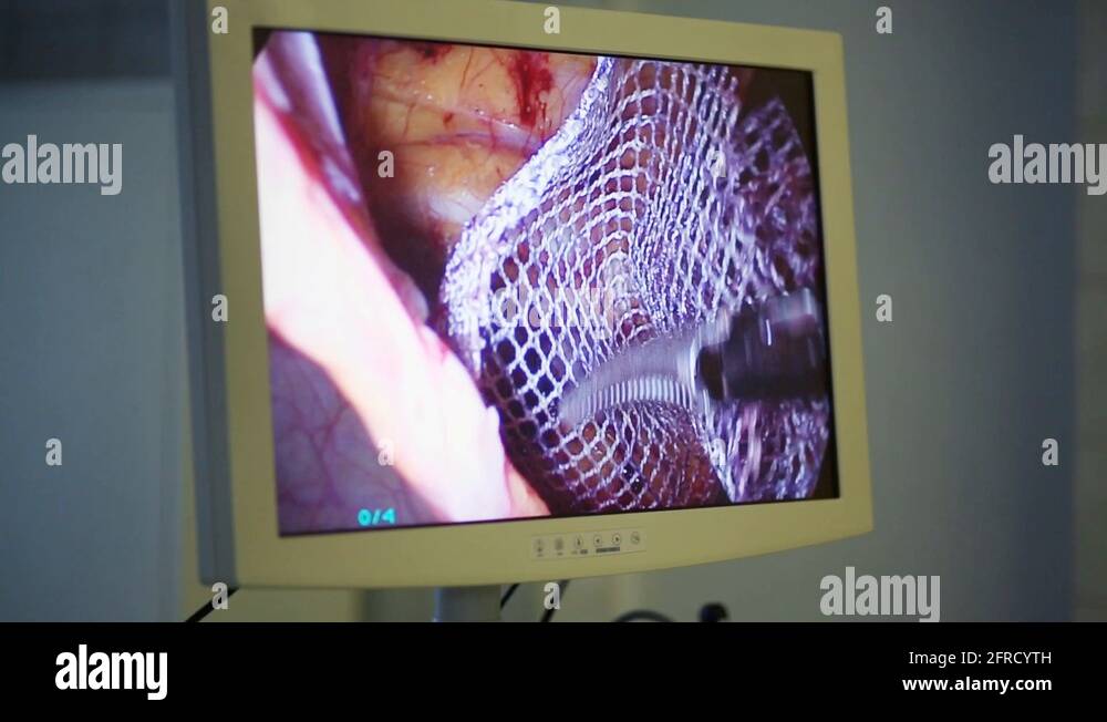 Display showing endoscopic surgery in abdominal organ Stock Video ...