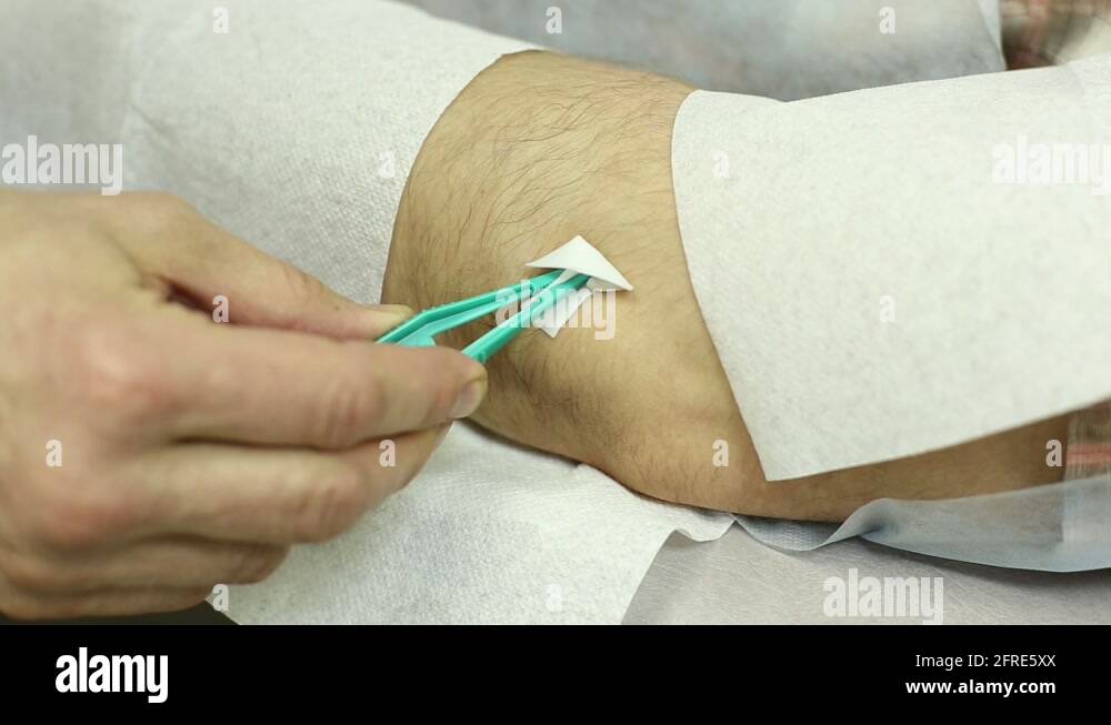 Doctor Cleans The Wound After Medicinal Leech Stock Video Footage - Alamy