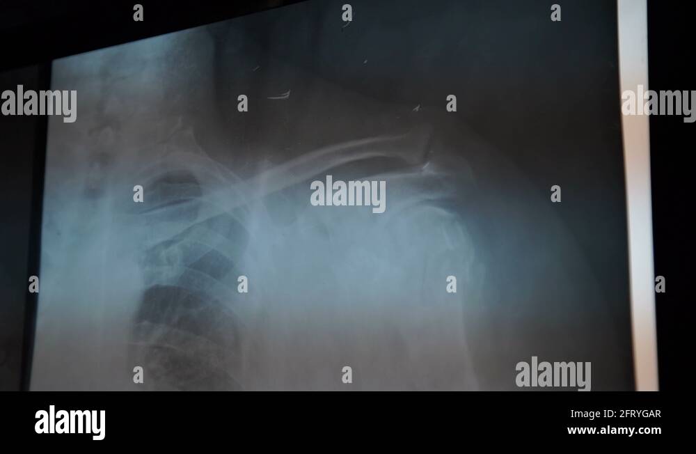 X ray shoulder Stock Videos & Footage - HD and 4K Video Clips - Alamy