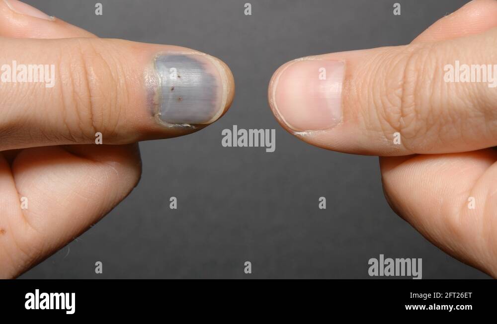 Blackened skin Stock Videos & Footage - HD and 4K Video Clips - Alamy