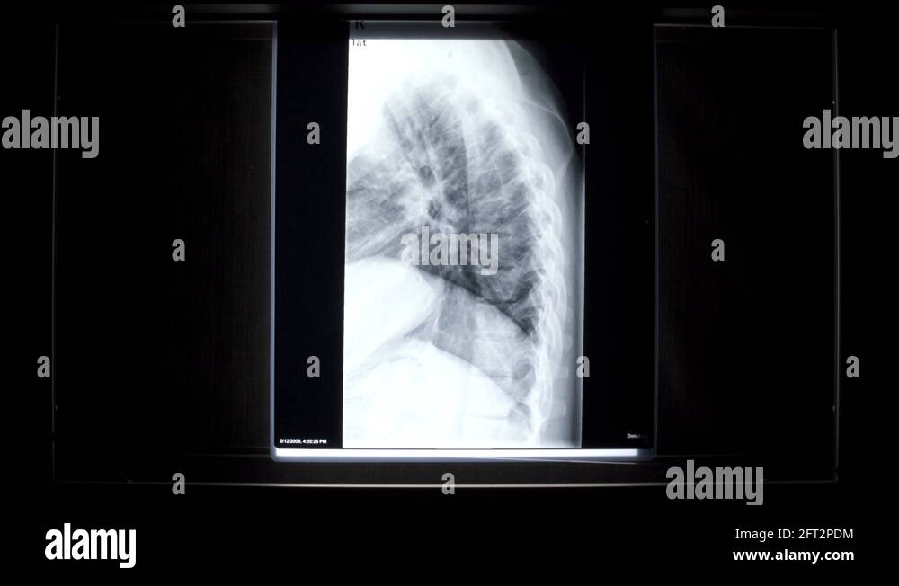 X-ray on illuminator panel - spinal cord Stock Video Footage - Alamy