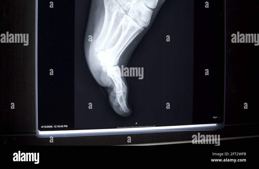 X ray scan foot Stock Videos & Footage - HD and 4K Video Clips - Alamy